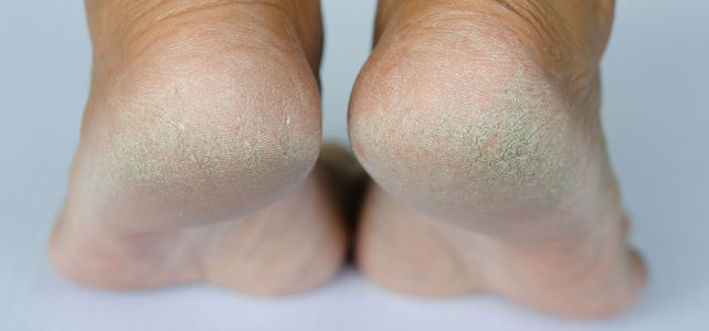A word of caution before removing heel calluses