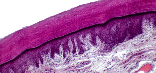 Skin tape stripping: Can it pave the way for early diagnosis in HS?
